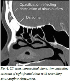 Minimally invasive approach for lesions involving the frontal sinus
