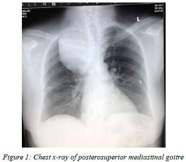 Mediastinal goitre - a South African case series