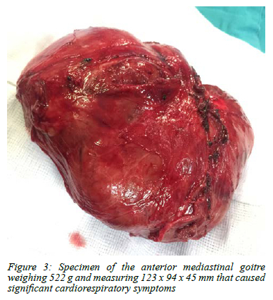 Mediastinal goitre - a South African case series