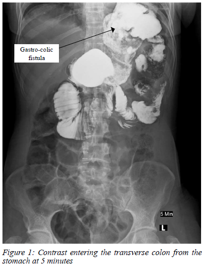 Gastro-colic fistula - a rare iatrogenic complication of Nissen ...