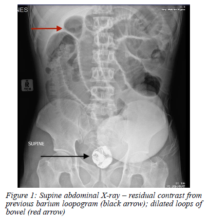 Incarcerated trans-stomal herniation resembling a stomal prolapse - a ...