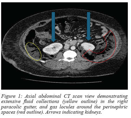 Retroperitoneal necrotising fasciitis - perils of obesity and acute ...