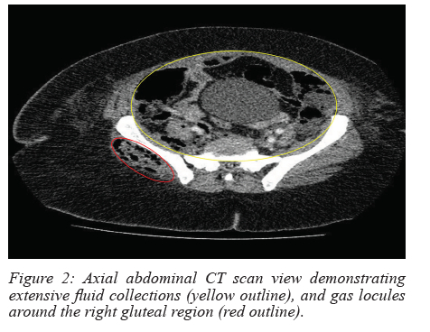 Retroperitoneal necrotising fasciitis - perils of obesity and acute ...