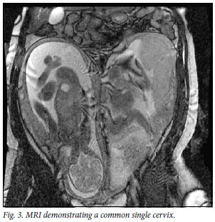 MRI of a twin pregnancy in a uterus bicornis unicollis