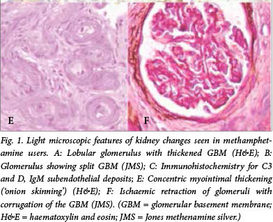 Hypertension, end-stage renal disease and mesangiocapillary ...
