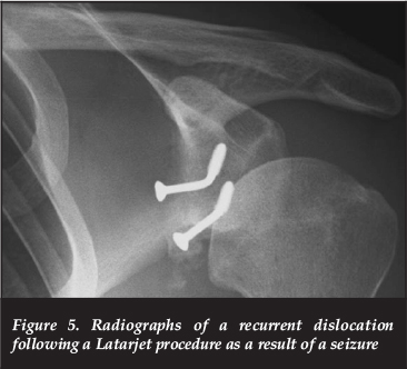 Early and medium-term complications of the modified Latarjet procedure