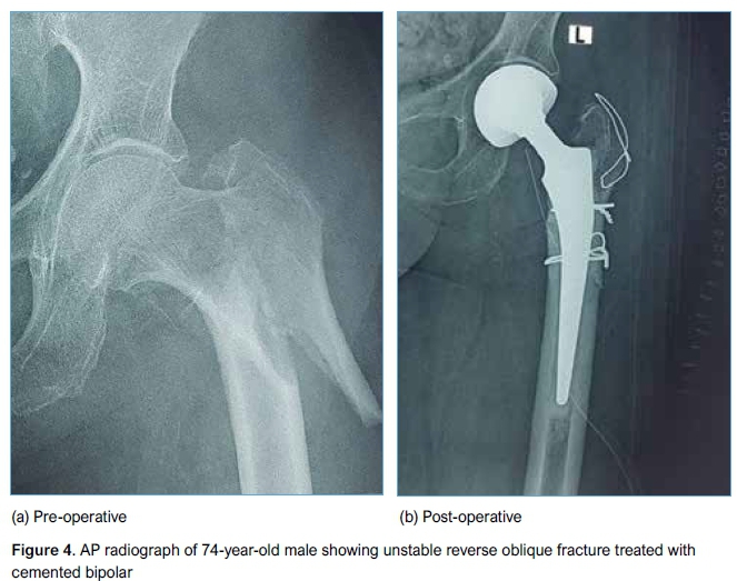 Unstable intertrochanteric fracture in elderly patients: outcome of ...