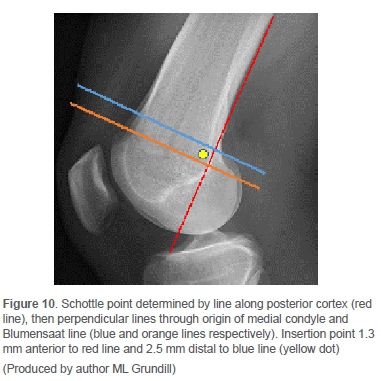 Patella dislocations and patellofemoral instability: a current concepts ...